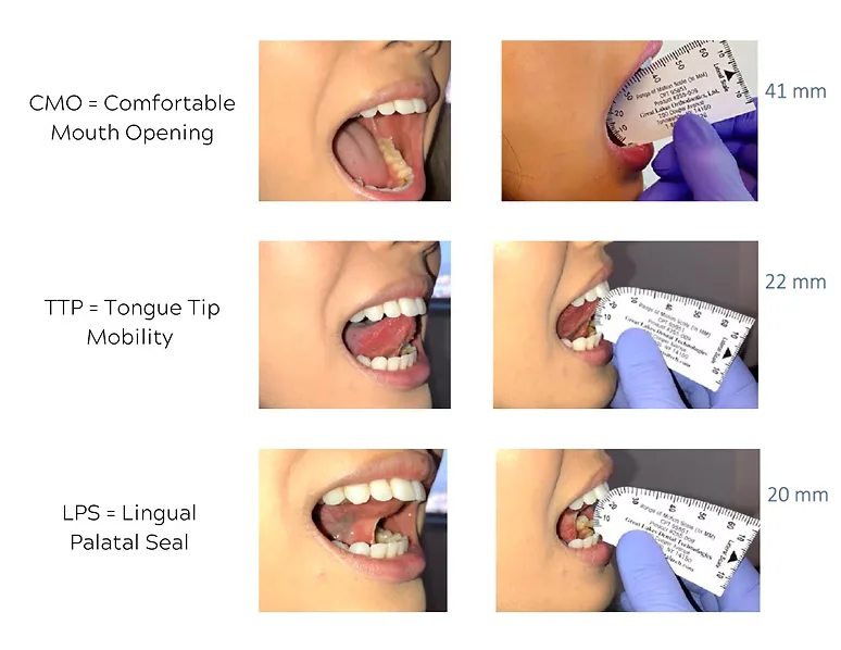How Flexible Is Your Tongue? Measure Your Mobility | Northstar Lip ...